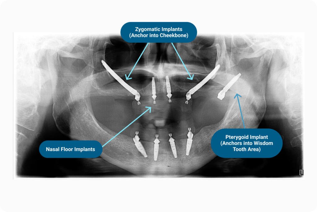 Do I Have Enough Bone for Dental Implants? - Dr Lampee Dentistry ...
