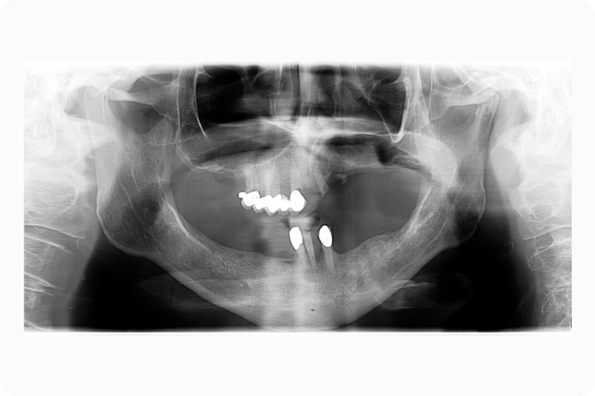 Zygomatic Implants – Dental Implants for Severe Bone Loss